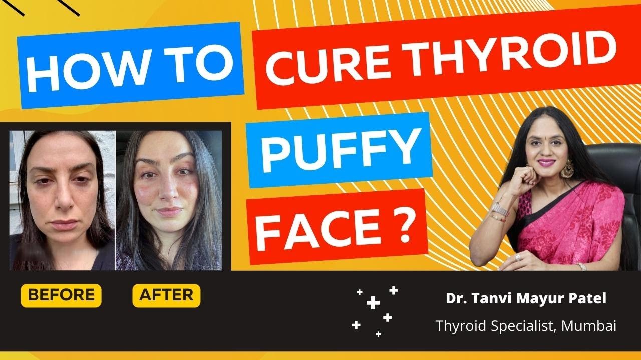How to cure Thyroid Puffy Face ? by Dr Tanvi Mayur Patel - YouTube