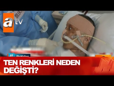 Ten rengi neden değişti? - Atv Haber 22 Nisan 2020