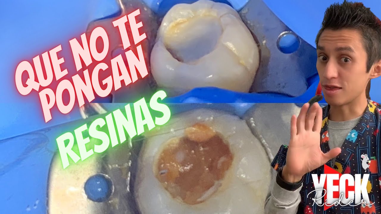 resina dental vs amalgama - YouTube