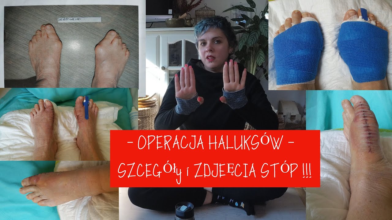 Operacja haluksów - Ceny, Zdjęcia, Opinia - bez NFZ - prywatnie ...