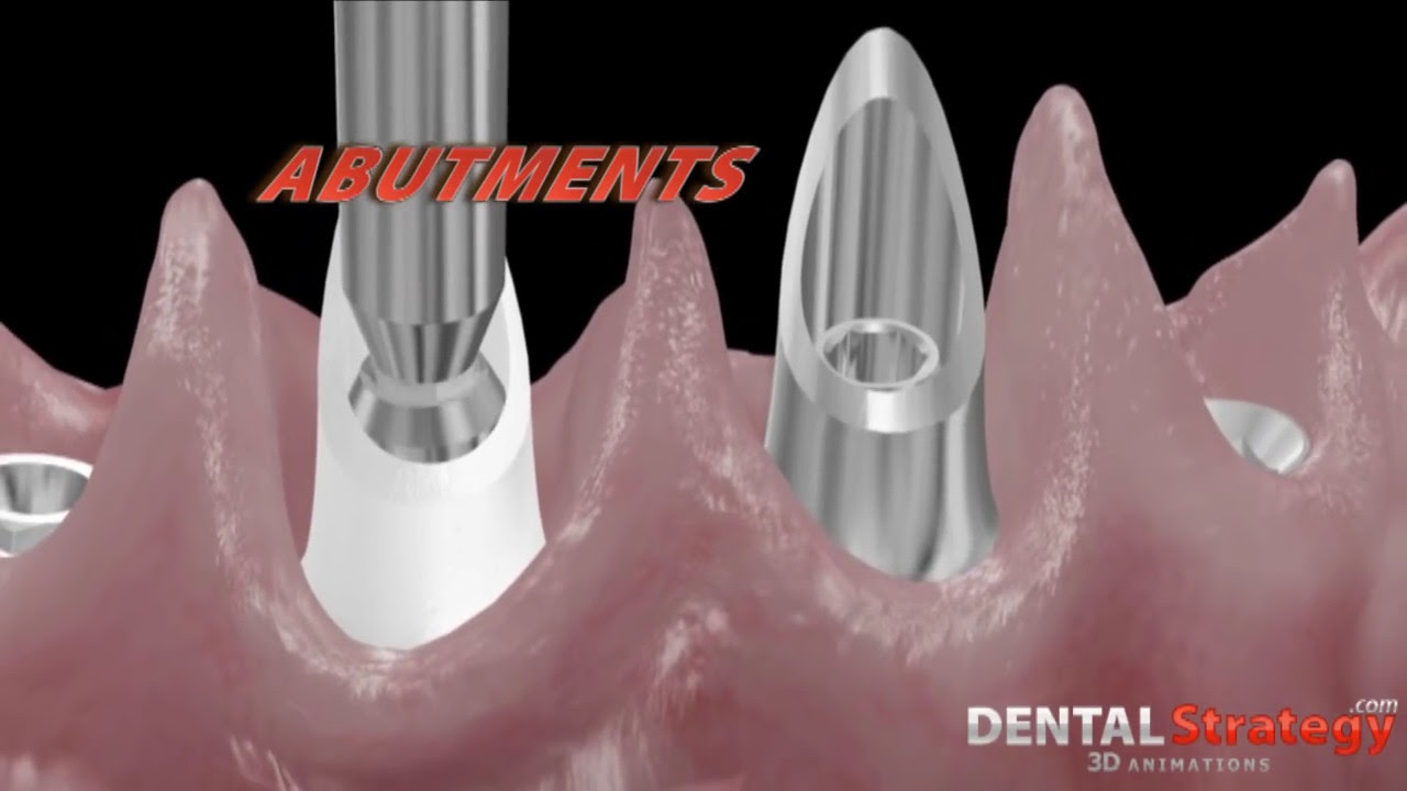 3d Dental Animation Implants Abutments Copings Crowns And Ceramic Sequence Youtube