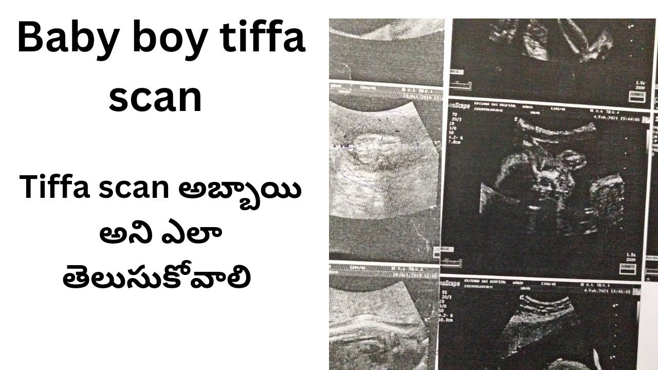 baby Boy Tiffa Scan How To Find Boy Gender Tiffa Scan In Telugu baby Boy Tiffa Scan How To Find Boy Gender Tiffa Scan In Telugu