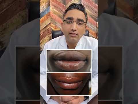 Are you uncomfortable with large lips? Is your lip hanging? Fix ...