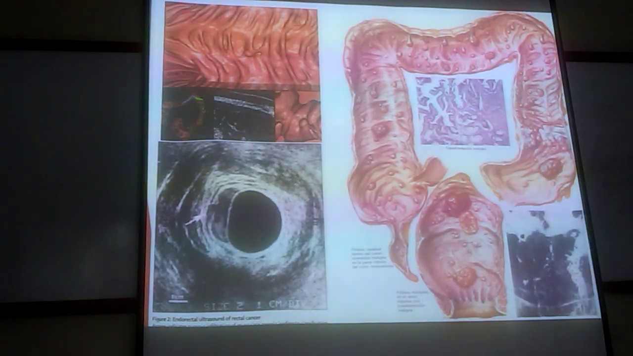 Cirugía General - Cáncer de Colon 3/4 - YouTube