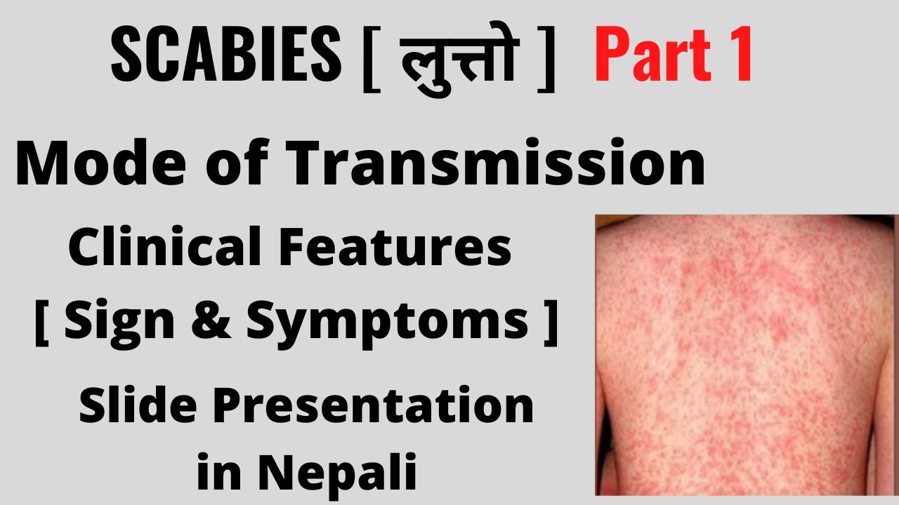 Scabies, Mode of Transmission and Clinical Features [ Sign & Symptoms ...