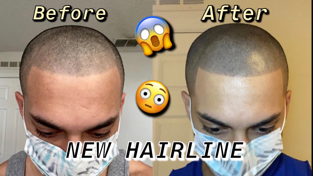 SMP 3rd Session! New Hairline! (Scalp Micro Pigmentation) - YouTube
