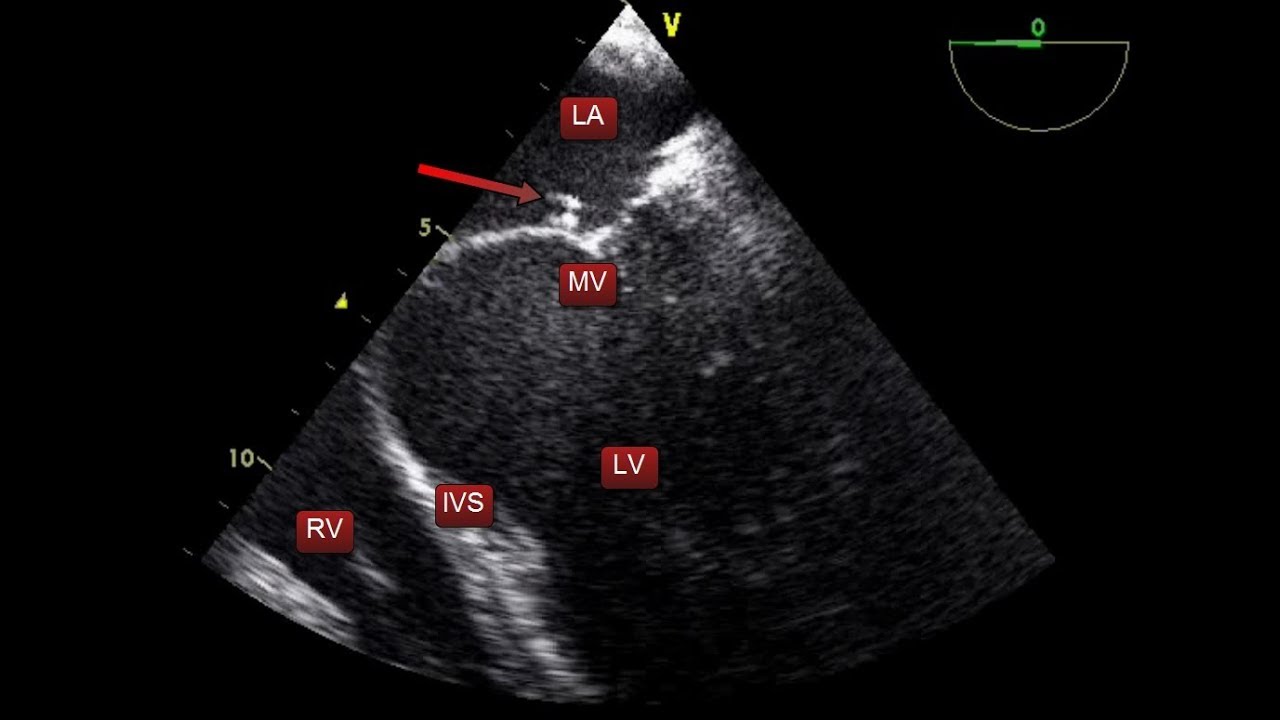 A simple transesophageal echocardiography quiz and introduction to TEE ...