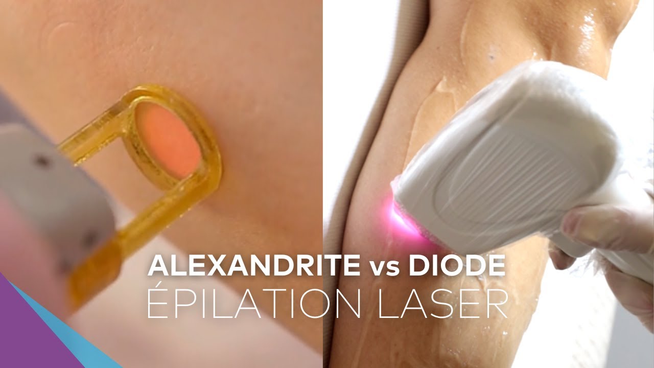 Épilation Laser : Alexandrite vs Diode Esthétique, quelles différences ...