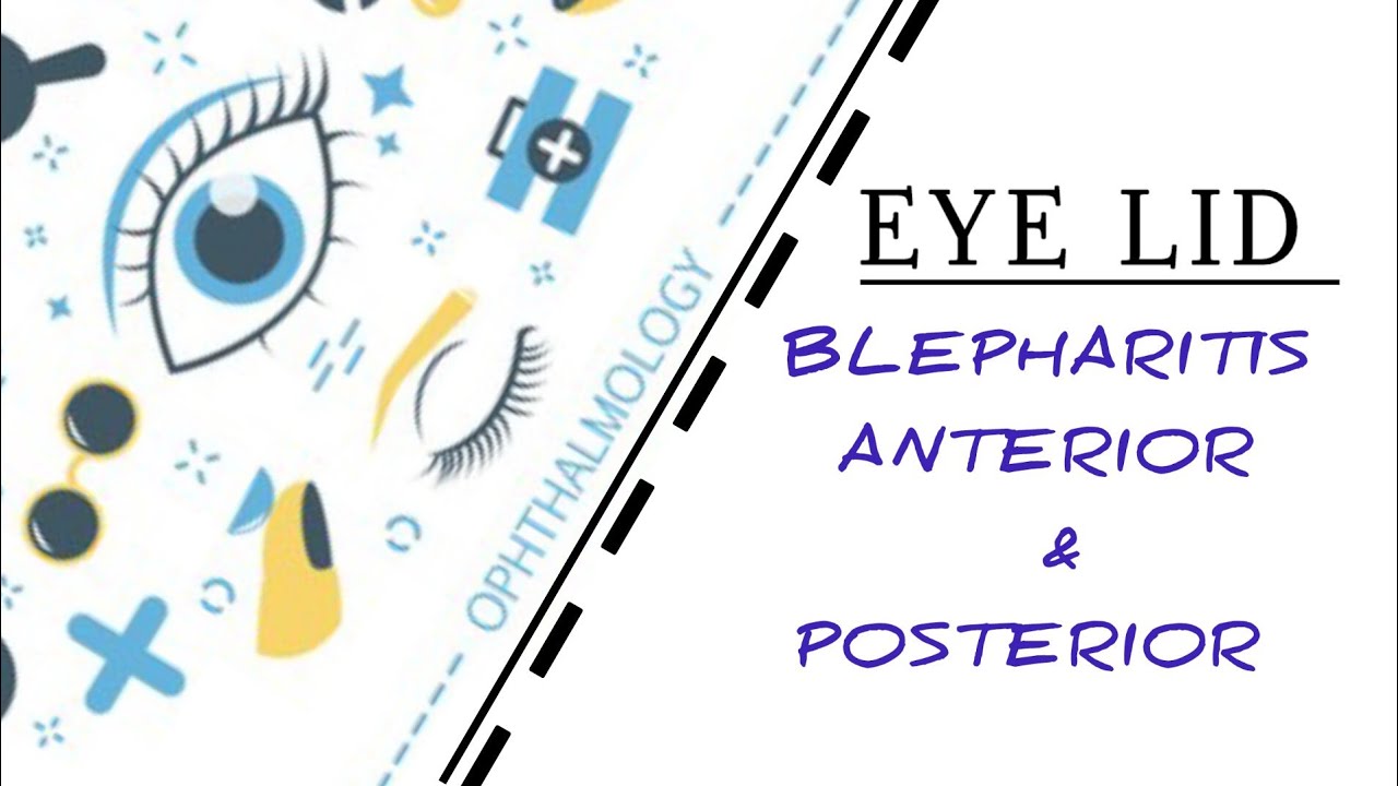 EYELID LECTURE-4 |ANTERIOR & POSTERIOR BLEPHARITIS| - YouTube