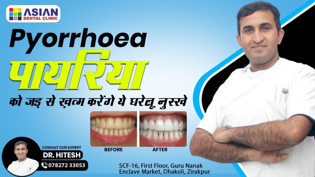 Asian Dental Clinic Pyorrhea video - YouTube