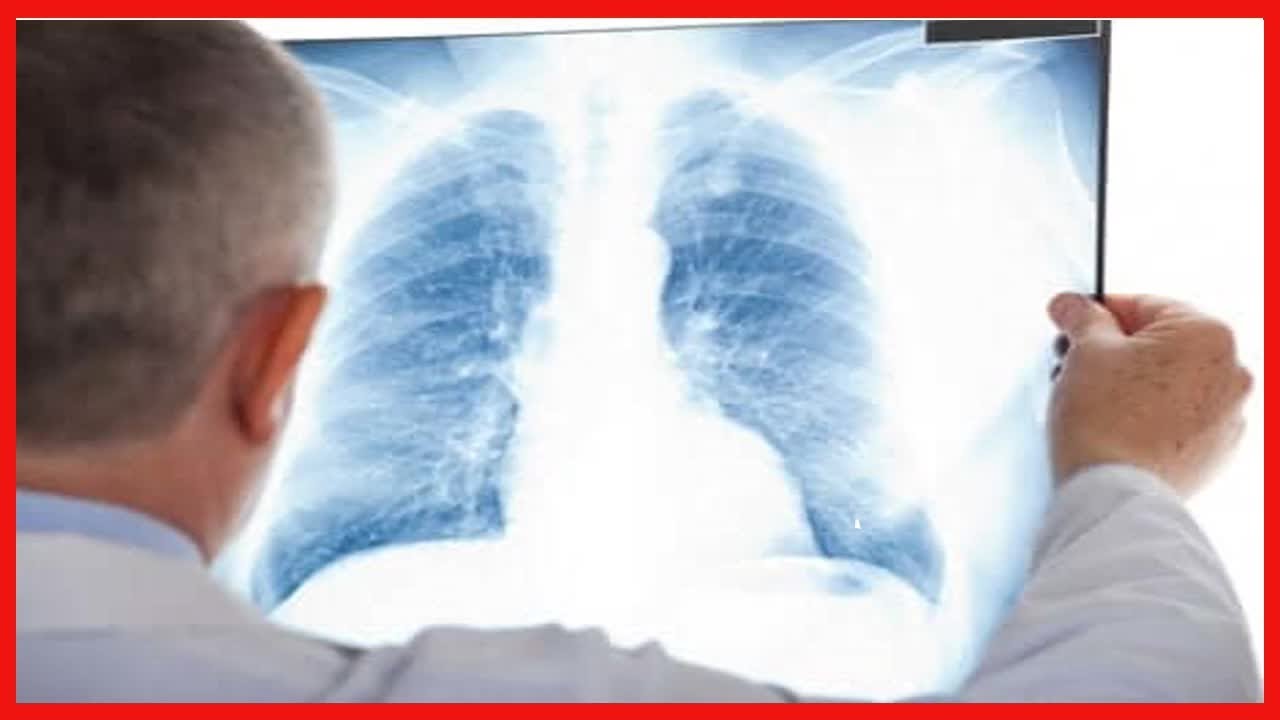 Pleurite: sintomas, causas e tratamento - YouTube