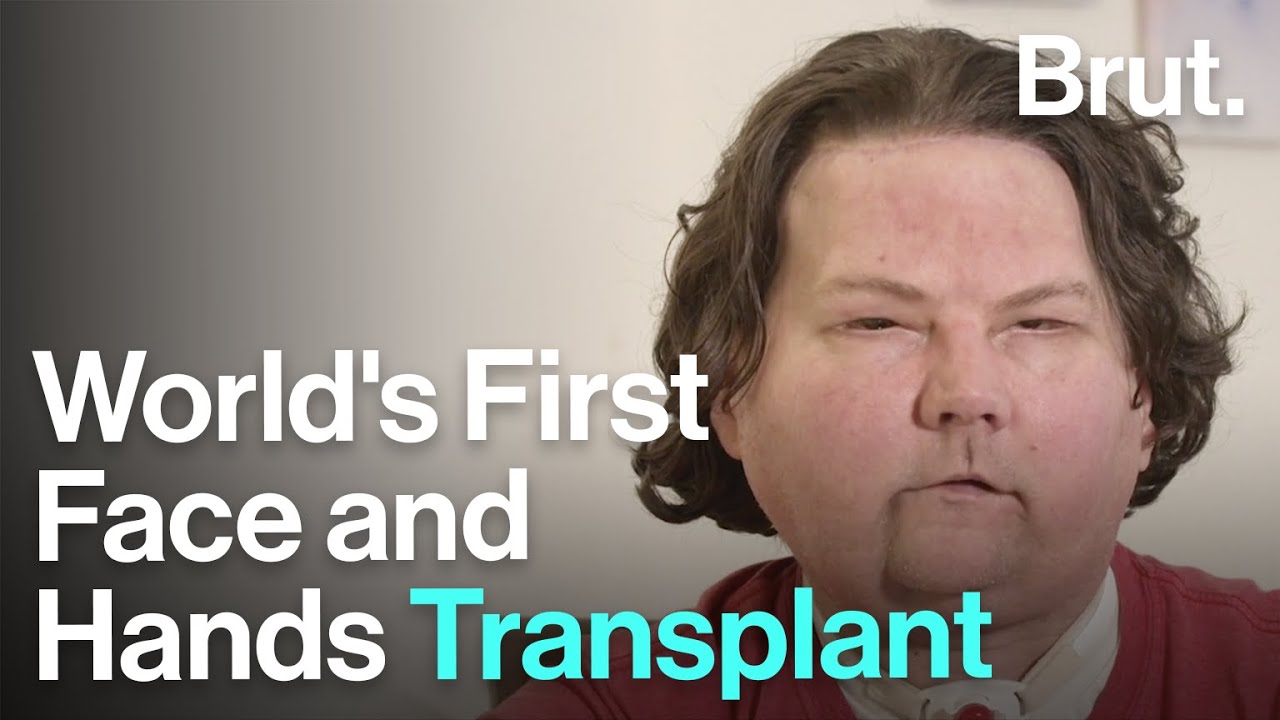 World's First Face and Hands Transplant - YouTube
