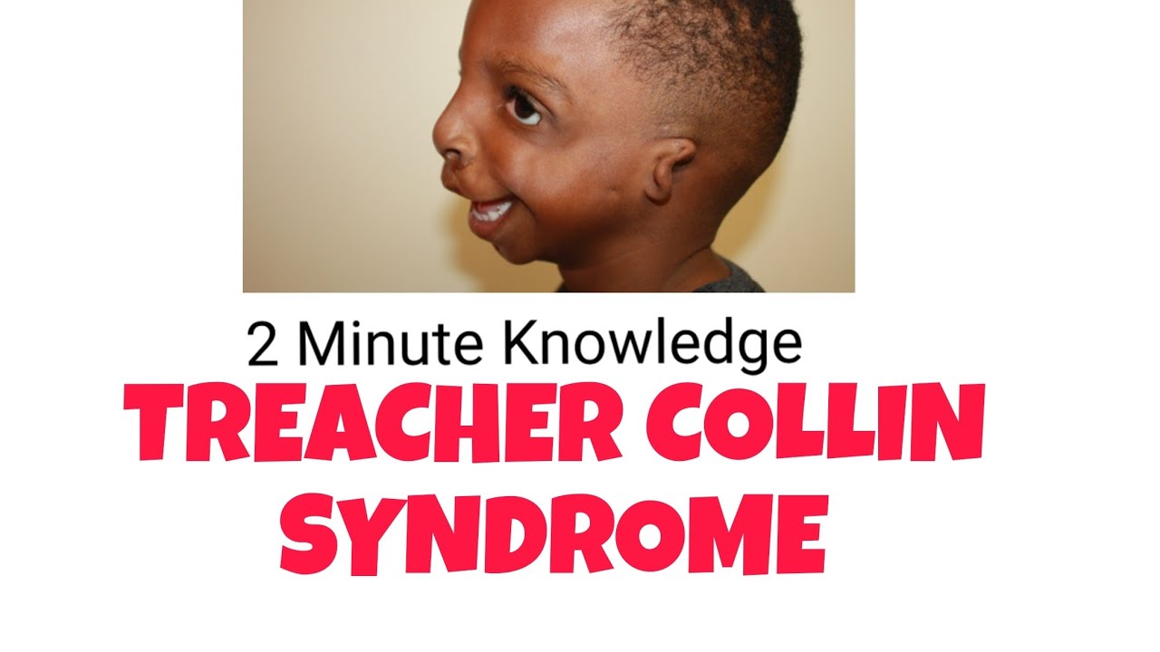 treacher Collin syndrome [2 minute knowledge] - YouTube