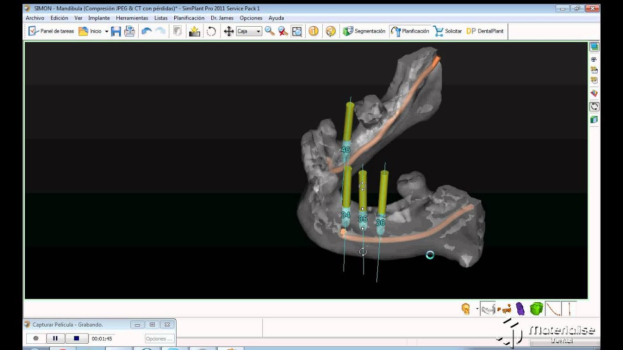 Simplant Pro - Clínica Dental AG - YouTube