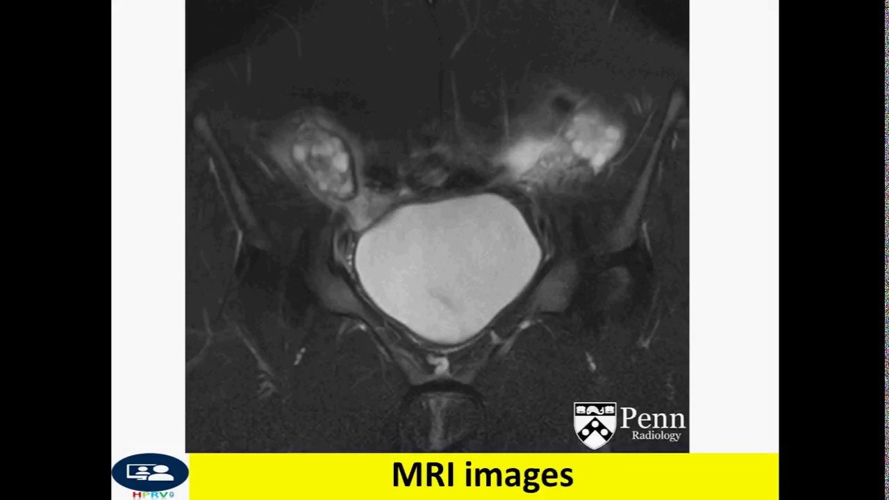 Mayer-Rokitansky-Küster-Hauser (MRKH) syndrome - YouTube