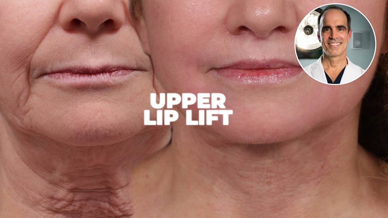 Instant Lip Transformation: Lip Lift Surgery Before and After | Achieve ...