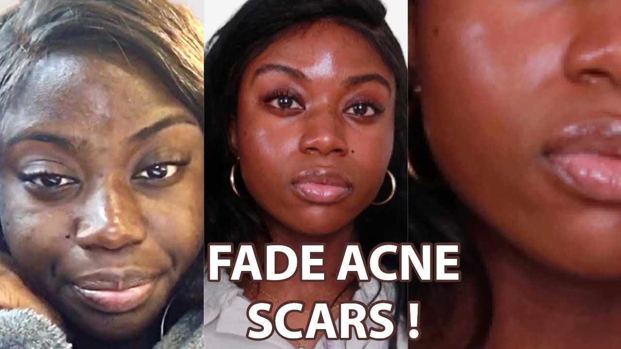 BEST INGREDIENTS TO FADE ACNE SCARS | Post Inflammatory ...