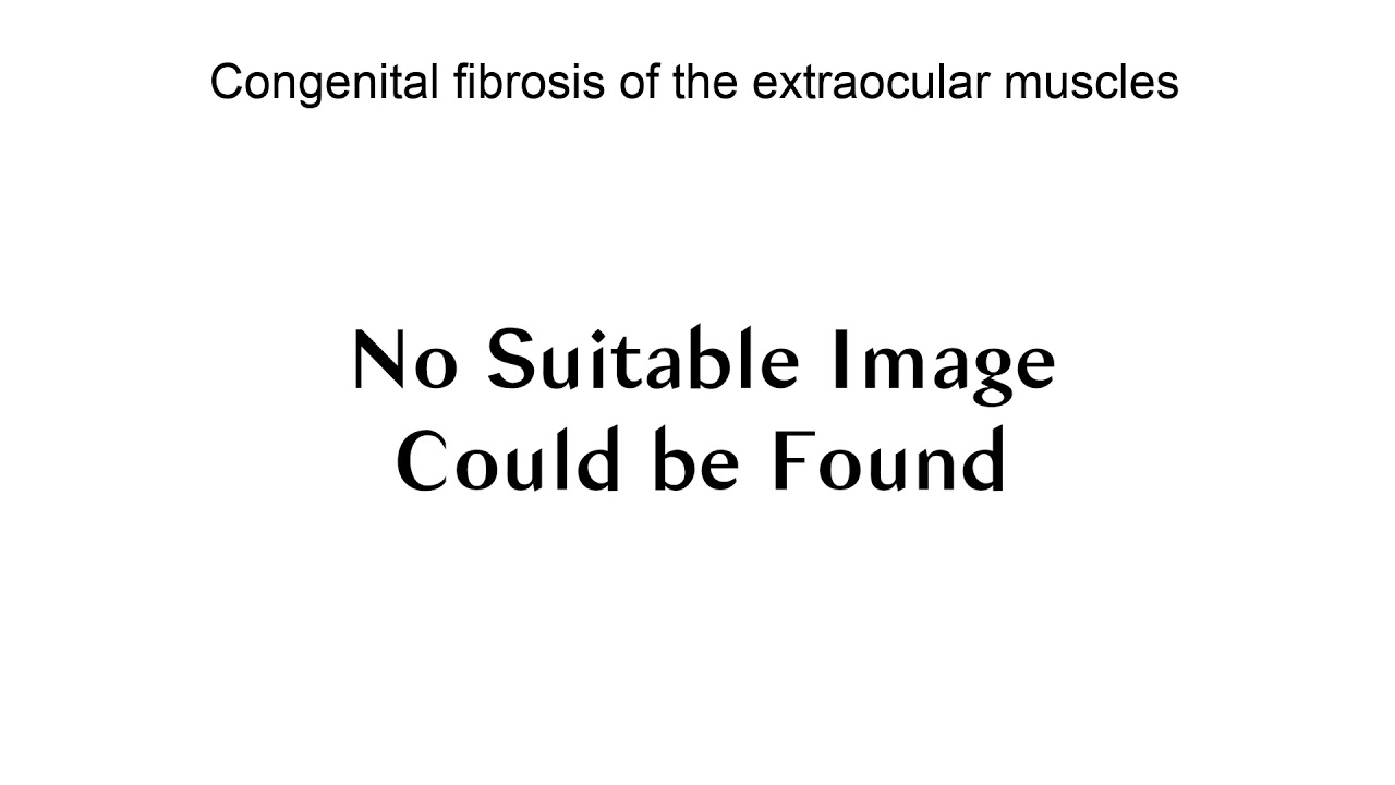 Congenital Fibrosis Of The Extraocular Muscles - YouTube