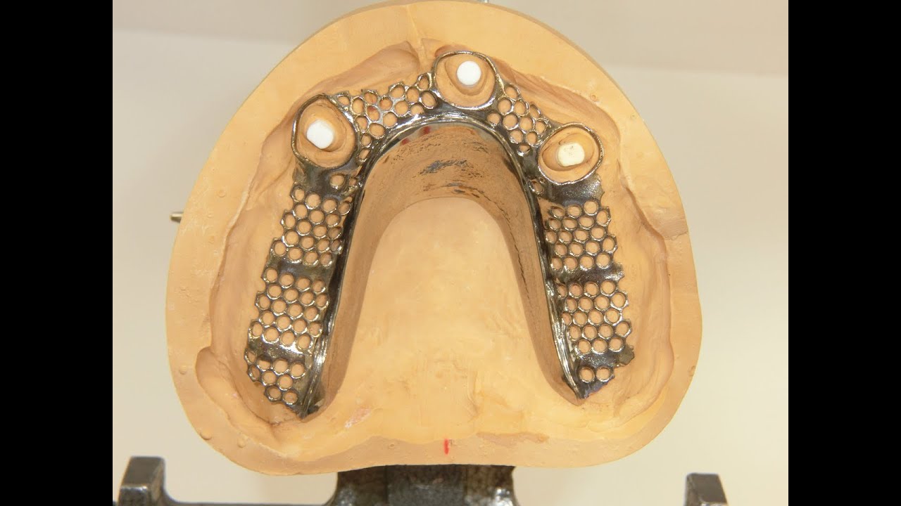 A Case of Magnetic Attachment Denture / 磁性アタッチメントを用いた義歯症例 - YouTube