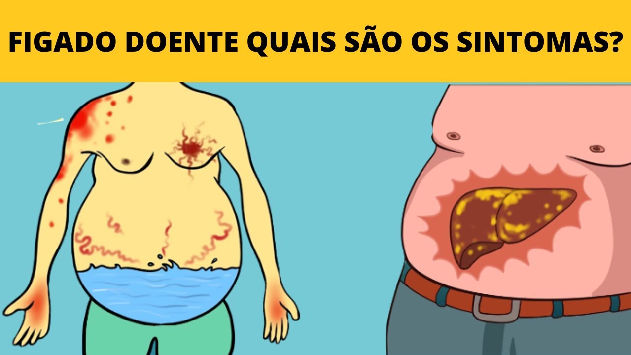 FIGADO DOENTE QUAIS SÃO OS SINTOMAS? E COMO TRATAR - YouTube