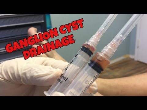 Draining a Ganglion Cyst from a Foot. Ganglion Cyst. - YouTube