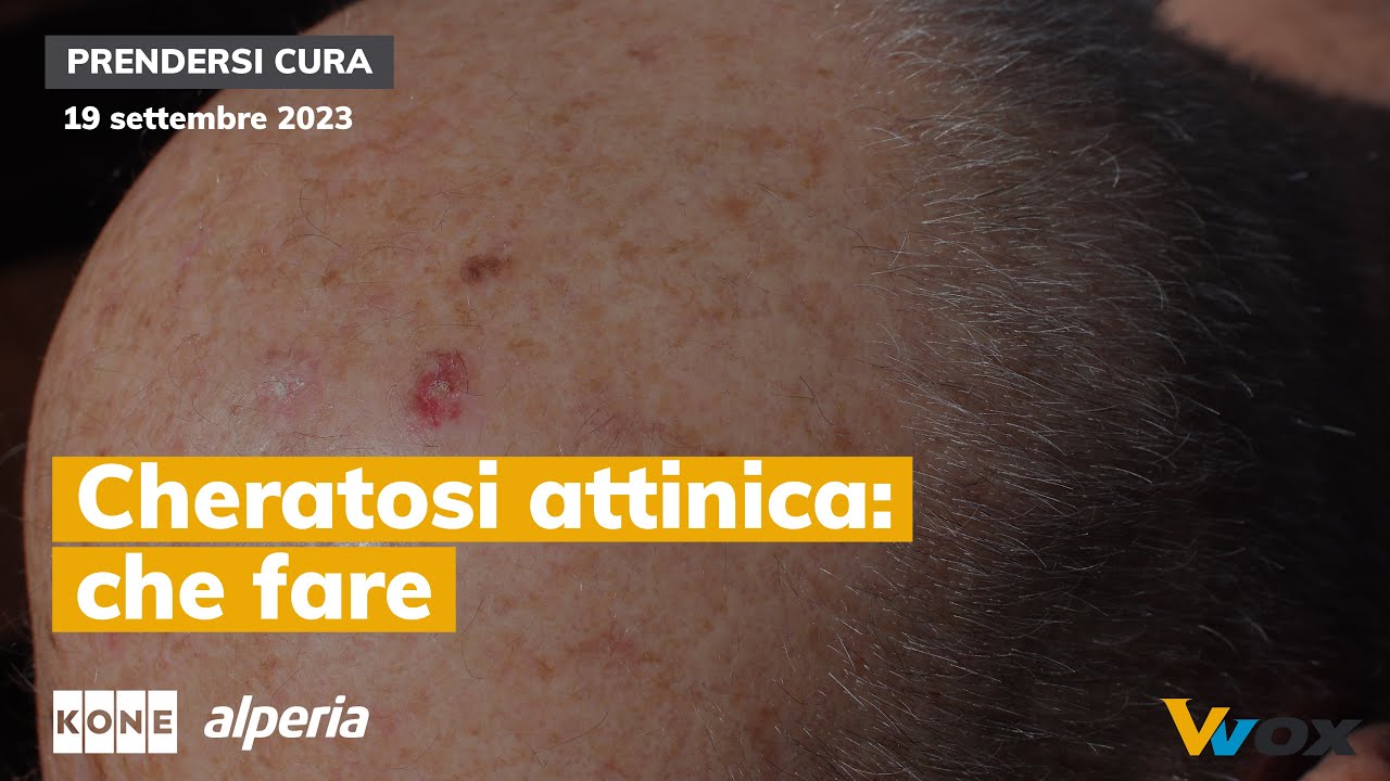 CHERATOSI ATTINICA: CHE FARE - YouTube
