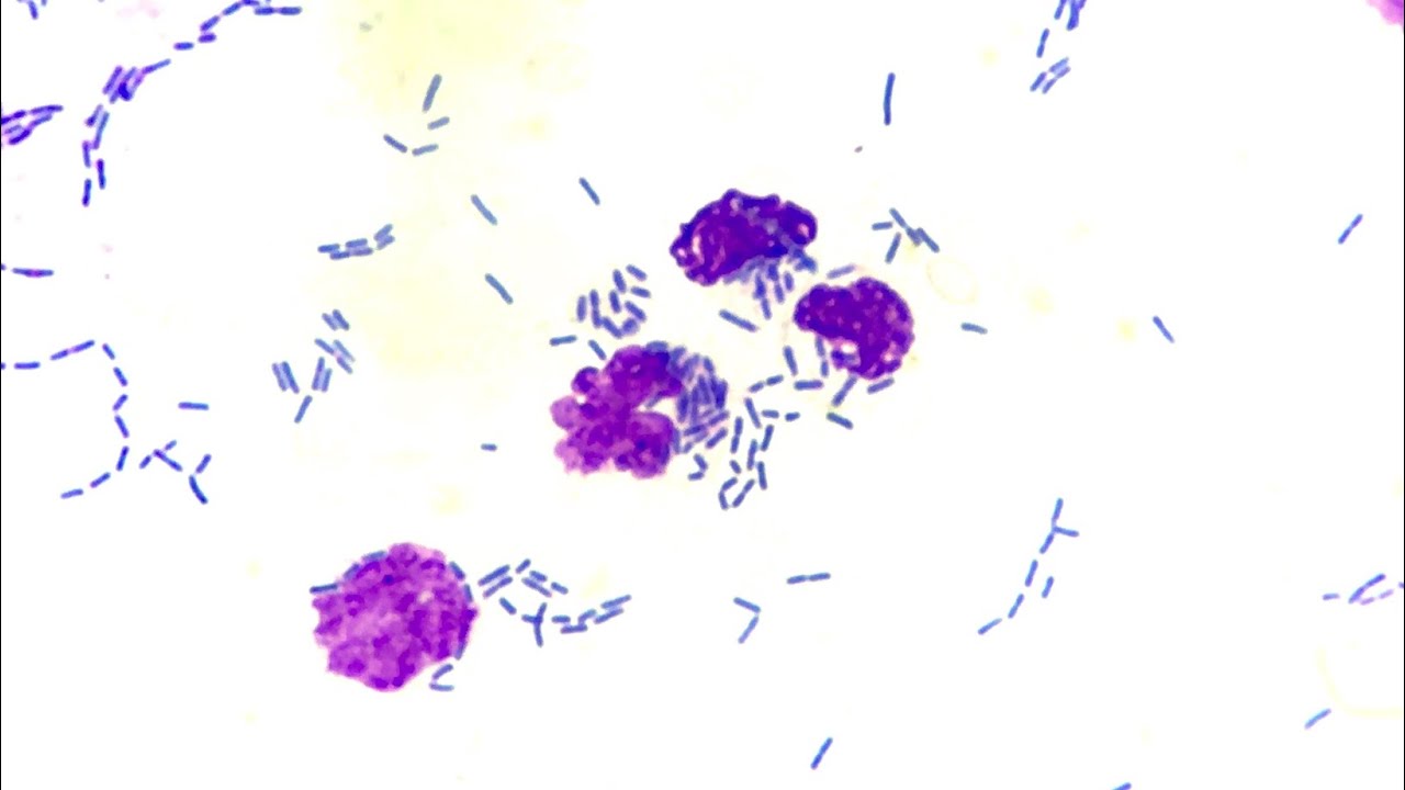 Urine Leucocytes With Bacteria YouTube urine-leucocytes-with-bacteria-youtube