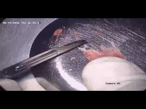 Copy of ENDAURAL TYMPANOPLASTY - YouTube