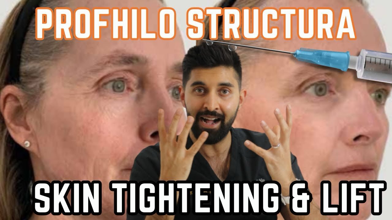 Profhilo Structura | What is it | Face Lift & Wrinkle Free | Is it ...