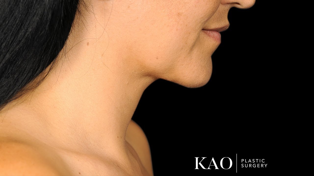 Micro Contouring of the Neck - Under Local Anesthesia - YouTube