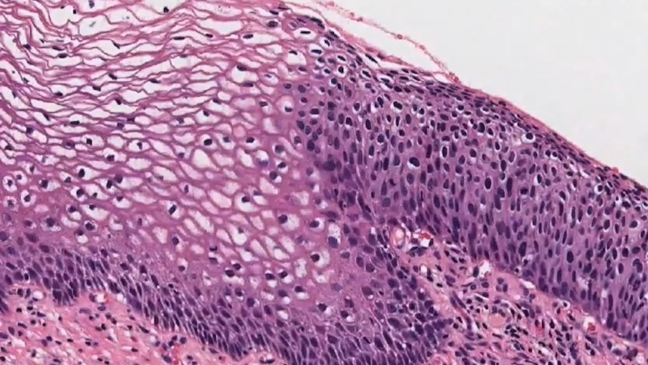 ¿Qué son las Lesiones Intraepiteliales de bajo y alto grado? - YouTube