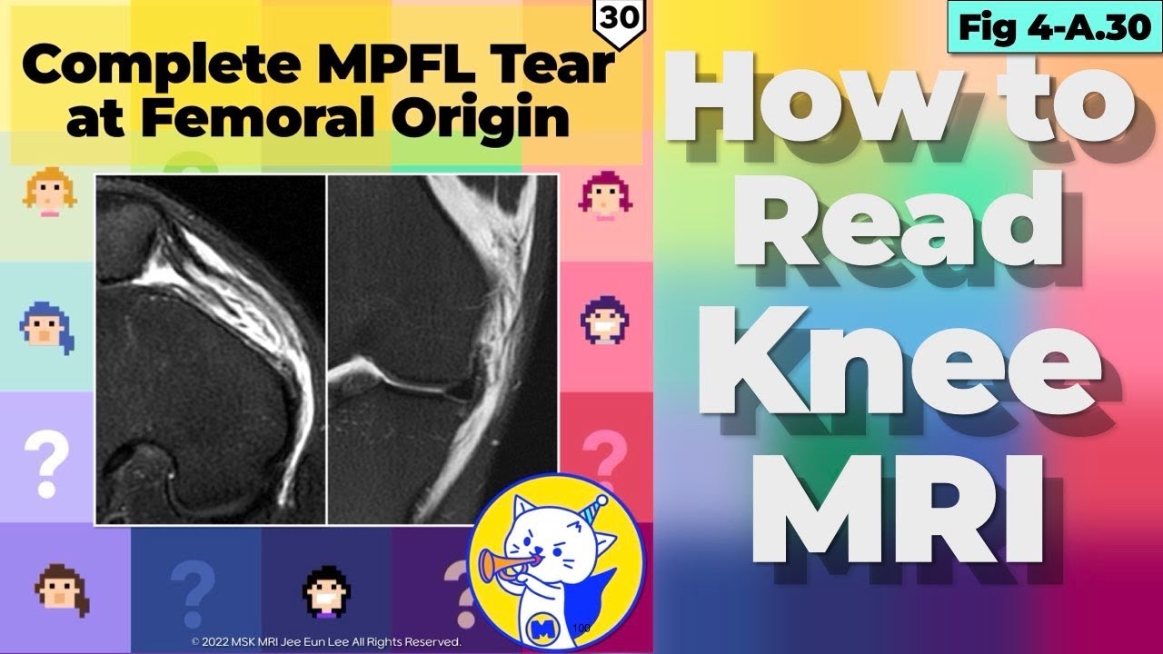 (Fig 4-A.30) Complete MPFL Tear at Femoral Origin - YouTube