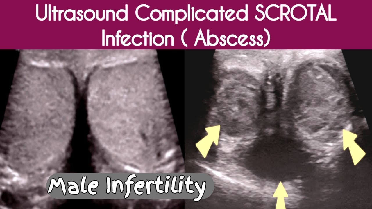 Complicated SCROTAL Infection - Abscess | Ultrasound | Male Infertility ...