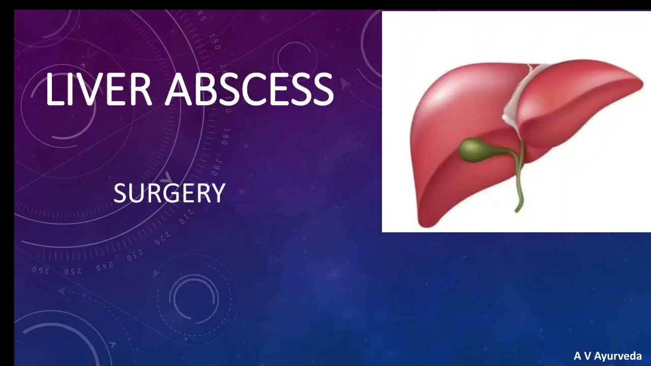 Amoebic liver abscess/part-2/liver abscess/Surgery/Shalya tantra - YouTube