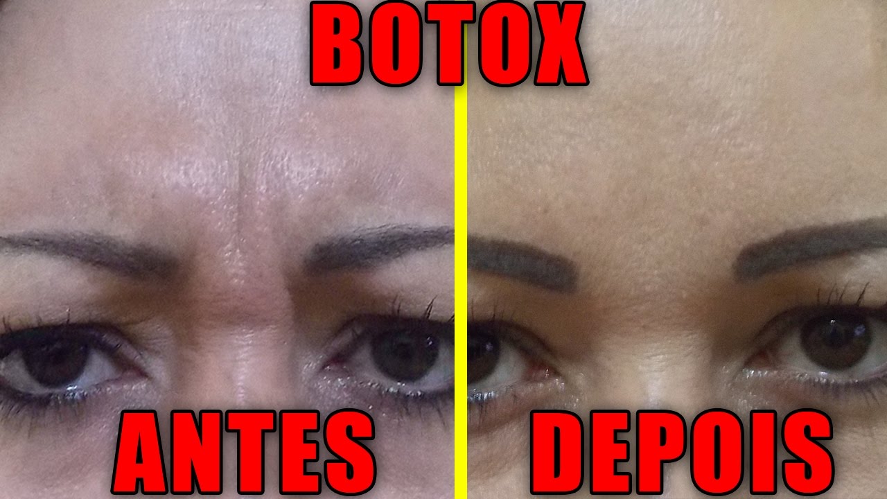 BOTOX NO ROSTO * FAZER OU NÃO ? - YouTube