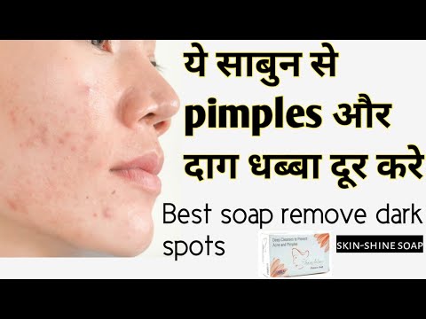 Best soap for remove pimples and acne| Remove dark spots| Antifungal ...