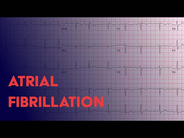 Atrial Fibrillation Rvr Ecg