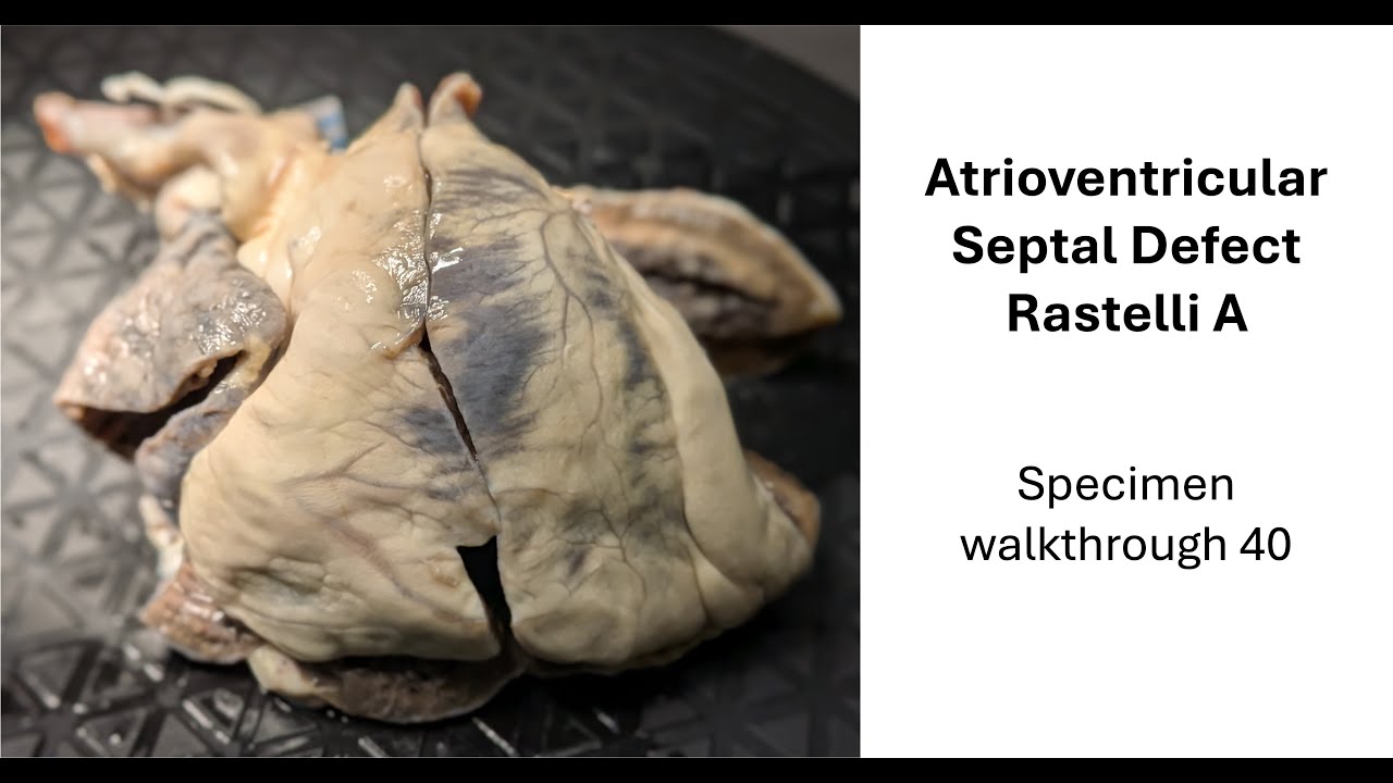 Specimen walkthrough 40- Atrioventricular septal defect Rastelli A ...