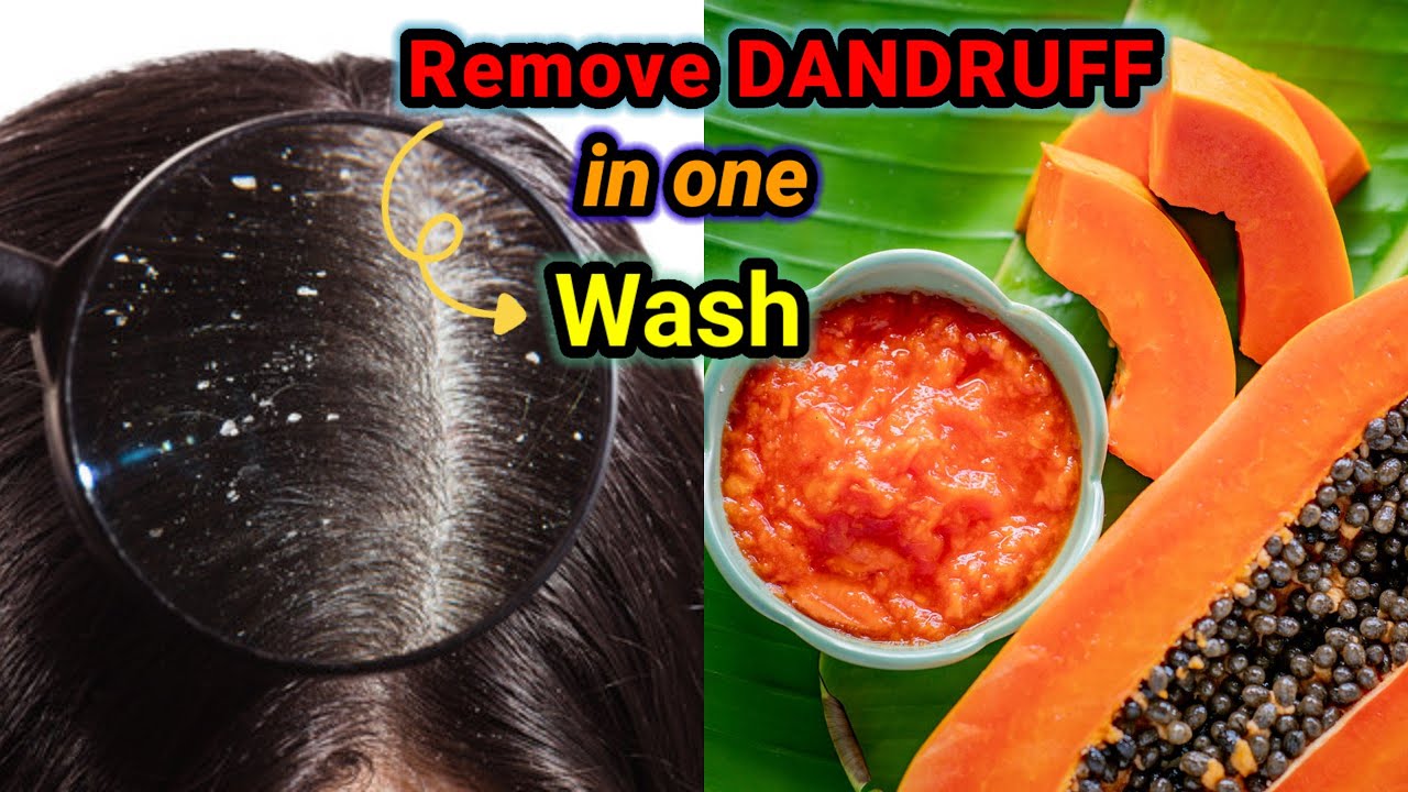 Dandruff Treatment At Home Remove Dandruff From Hair In One Wash