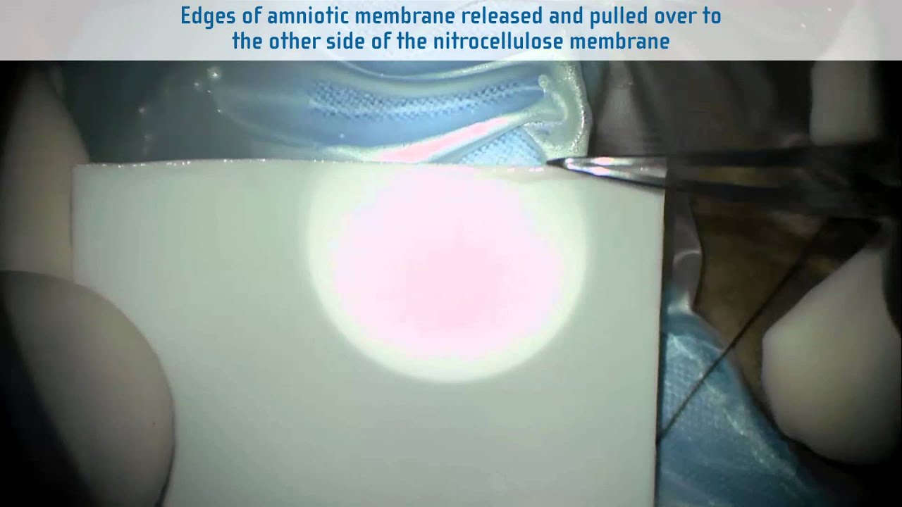 Video to illustrate the Use of Cryopreserved Amniotic Membrane as a ...