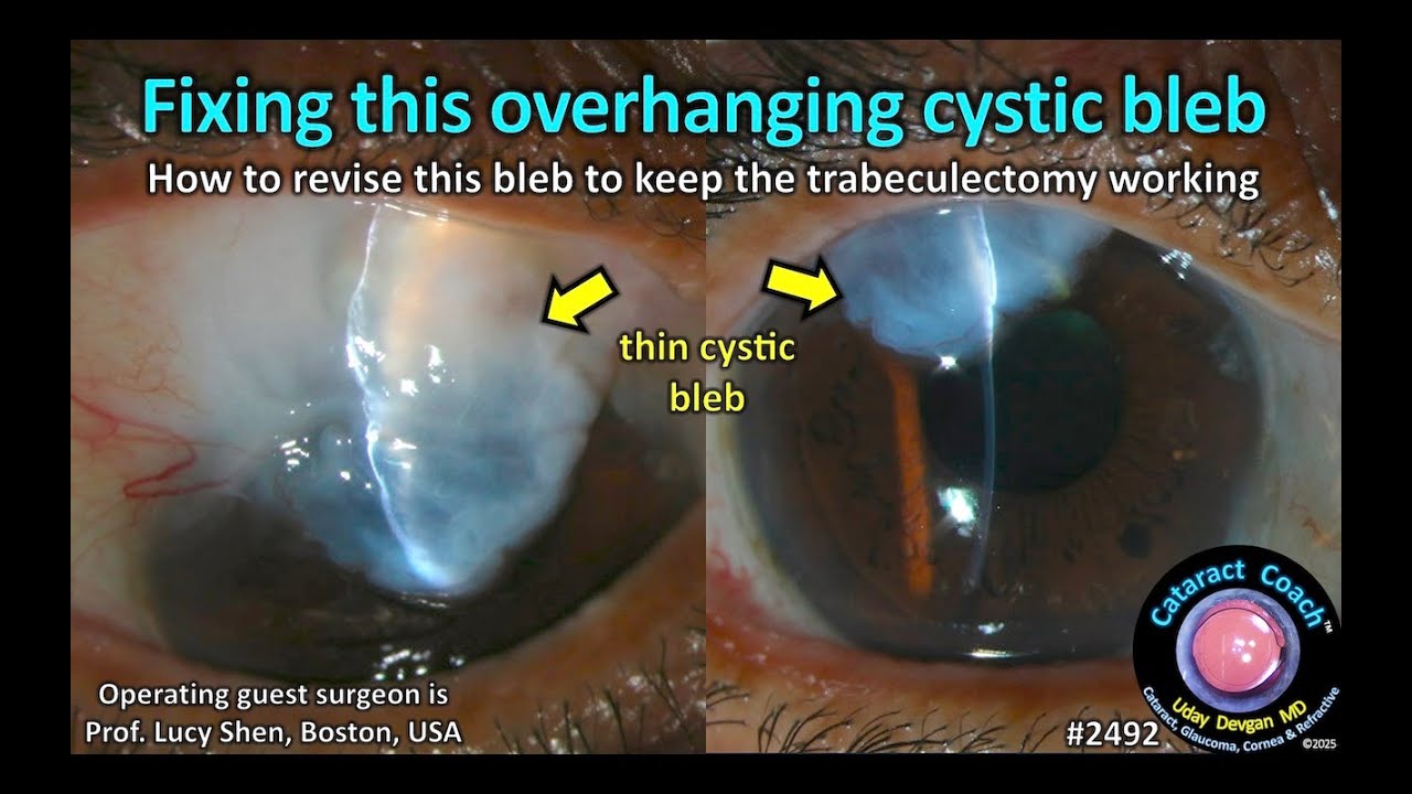 CataractCoach™ 2492: fixing this overhanging cystic bleb - YouTube