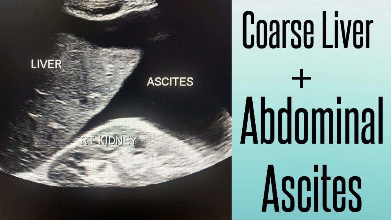 Coarse Liver & Abdominal Ascites on Ultrasound | Chronic Liver Disease ...