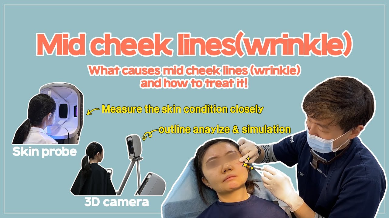 [HUSHU]Mid face lines treatment - Improve mid cheek lines/wrinkles by ...