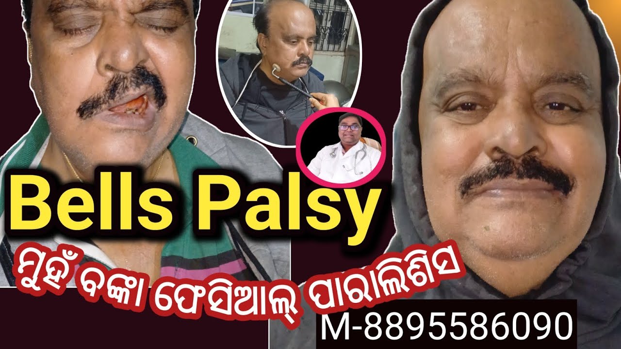 #Bells Palsy#Facial paralysis #बेल्स पाल्सी #ମୁହଁ ବଙ୍କା ହୋଇ ପାରାଲିଶିସ ...