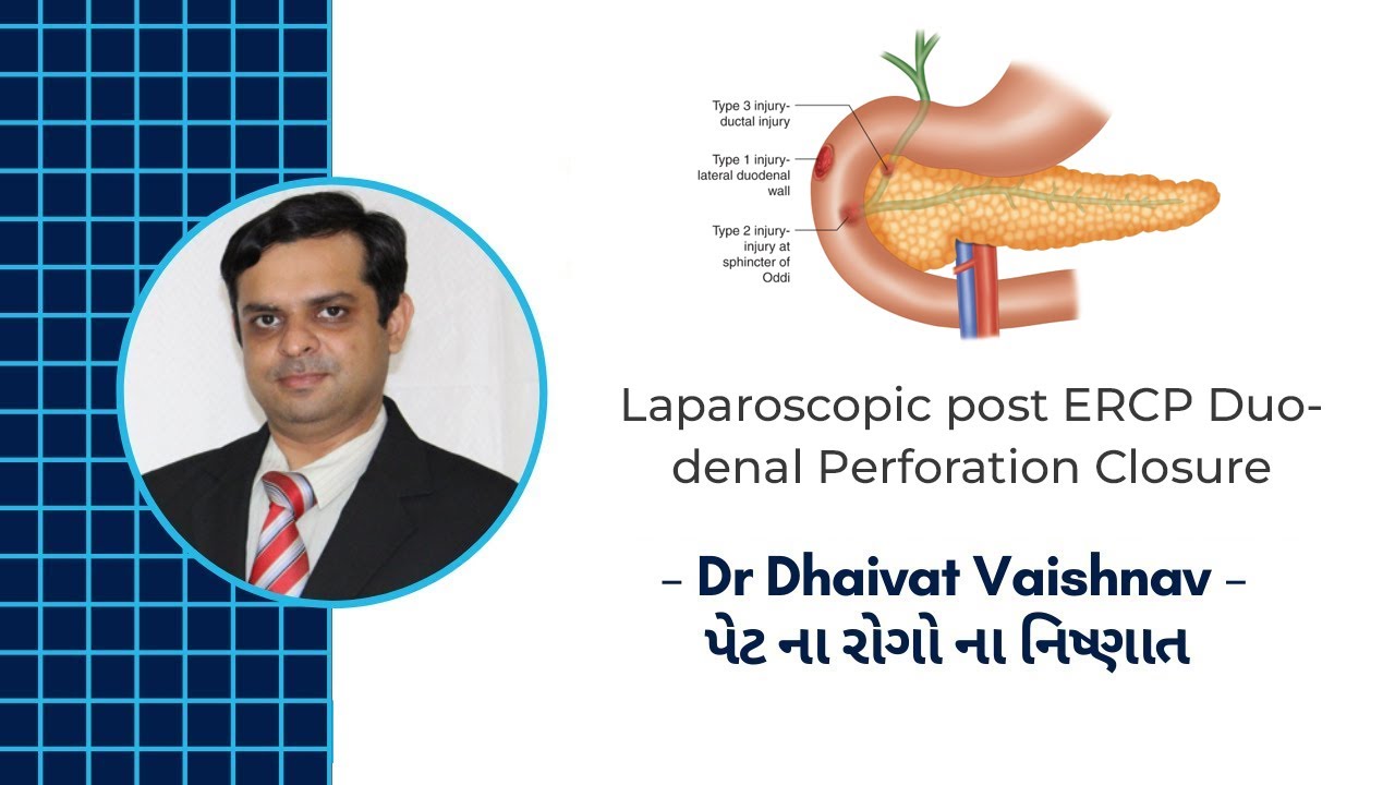 Laparoscopic post ERCP Duodenal Perforation Closure Dr Dhaivat Vaishnav ...