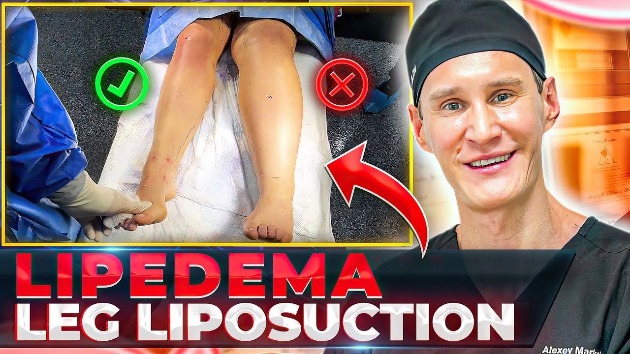 No More Stubborn Fat! Tumescent Liposuction Technique for Lipedema ...