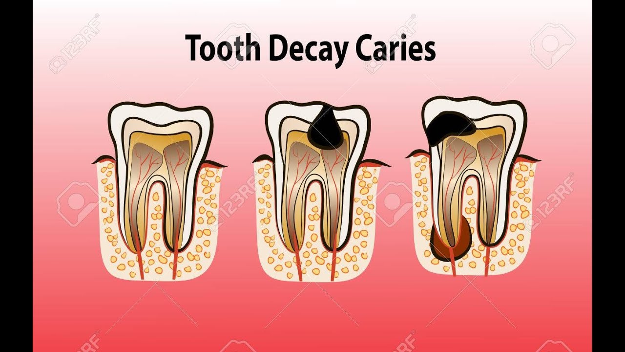 Dental Caries: Defintion, Causes,Sign n Symptoms, Pathophysiology ...