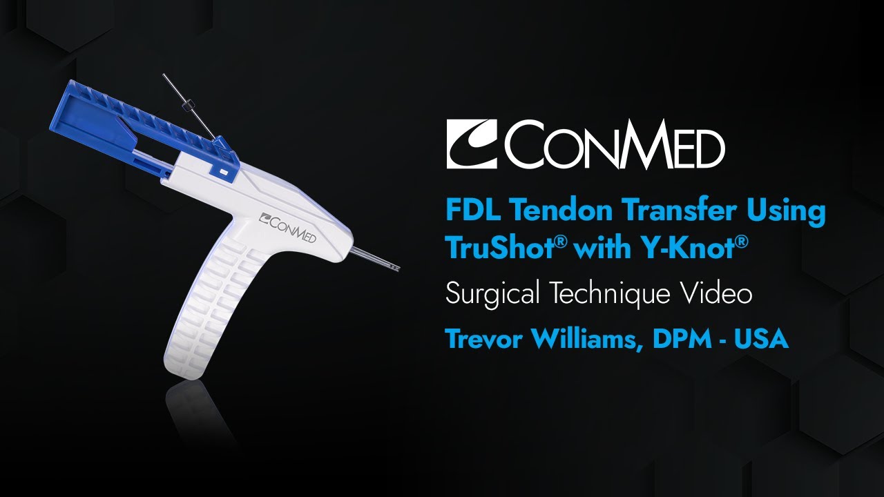 Dr. Trevor Williams - FDL Tendon Transfer Using TruShot® with Y-Knot ...