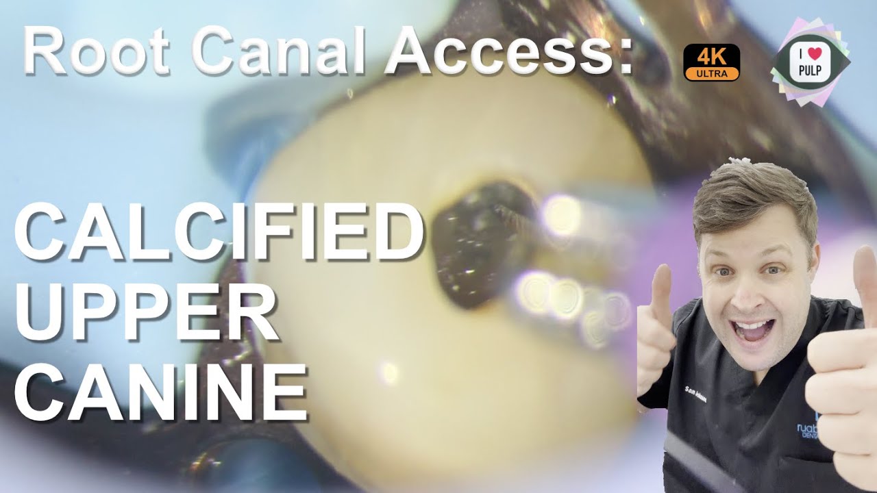 Best way to Access a sclerosed canal | 4K Resolution - YouTube