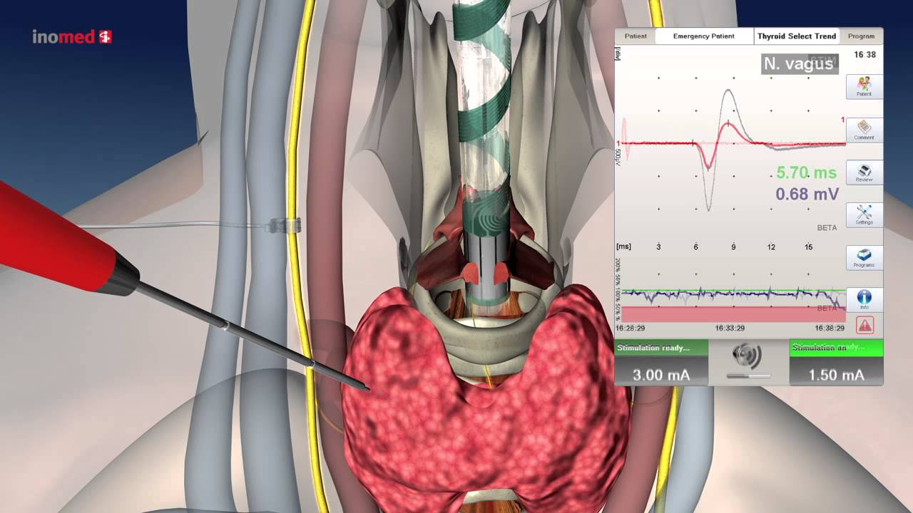 C2 NerveMonitor - YouTube